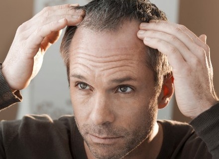 Best Hair Loss Treatments For Men - That Actually Work!